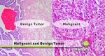 Difference Between Malignant and Benign Tumor - biomadam